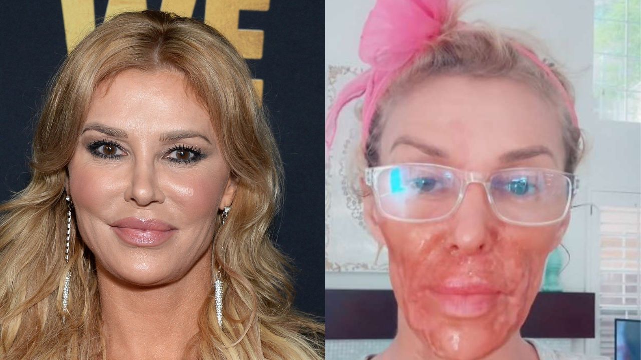 RHOBH: Brandi Glanville Lost A Lot Of Money Due To Facial Burns ...